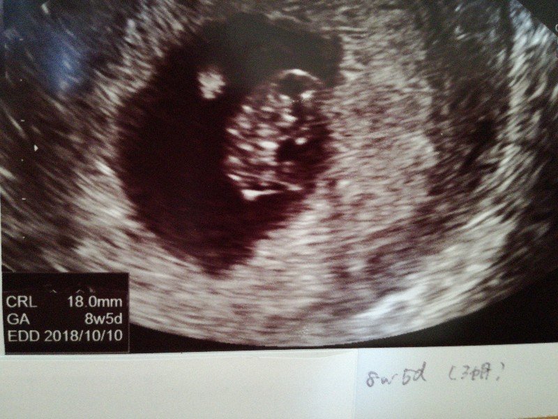 8w5d/胎児の大きさ・エコー。総合病院と個人病院どっちが良い？ | てんの育児キロク
